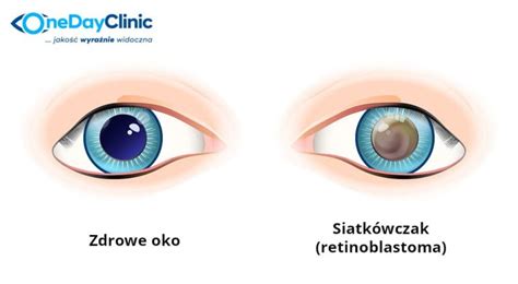 Siatkówczak rak oka siatkówczak u dziecka siatkówczak objawy guz