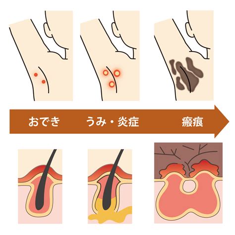 化膿性汗腺炎～繰り返す痛いおでき（名古屋市立大付属東部医療センター 岩井敦子准教授）～｜トピックス｜時事メディカル｜時事通信の医療ニュースサイト