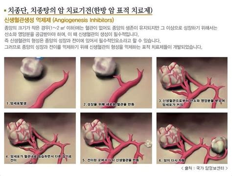 림프종 초기증상 네이버 블로그