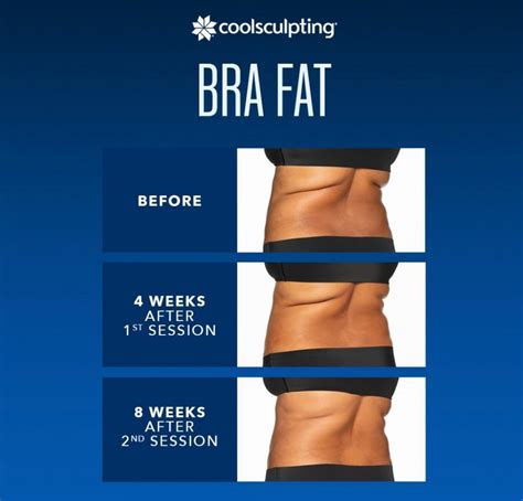 Coolsculpting Elite Is Here Revive™ Medical Spa Medical Spa