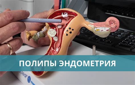 Полип эндометрия Рецидив полипов эндометрия Дмитрий Оводенко Онкогинеколог гинеколог