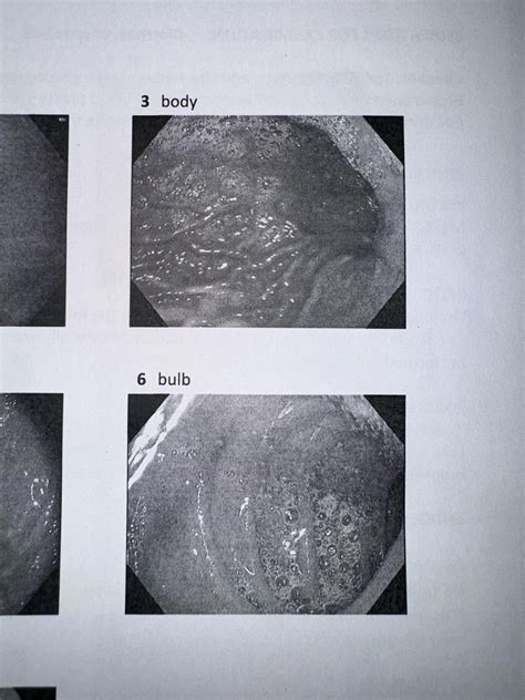 Egd Procedure Report Rmedicaladvice Egd Procedure Report Rmedicaladvice