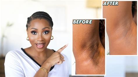 How I Got Rid Of My Dark Underarms How To Brighten Your Armpits Keep Them Even And Smooth