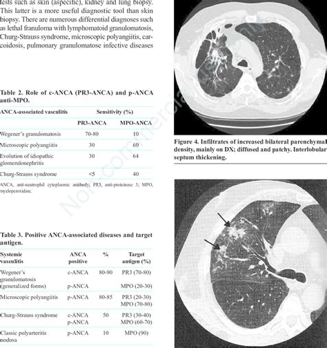 Patchy Infiltrates Download Scientific Diagram
