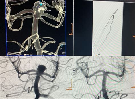 Zakarya Ali On Linkedin Transradial Y Stent Assisted Coiling Of