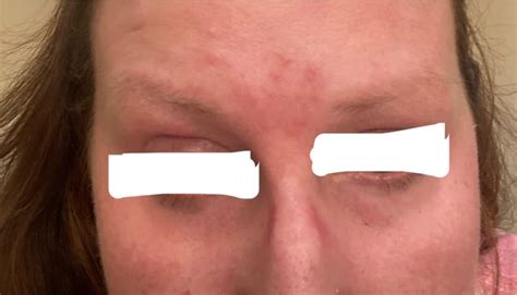 Rash Between Eyebrows Rdermatologyquestions
