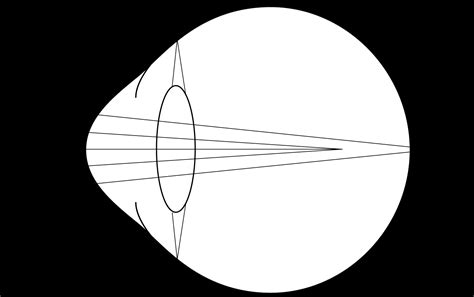 Lens Replacement Surgery — Kieren Darcy · Ophthalmologist · Vision