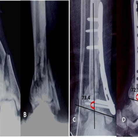Measurement Of Lateral Distal Tibial Angle Ldta And Length Of Lateral Download Scientific