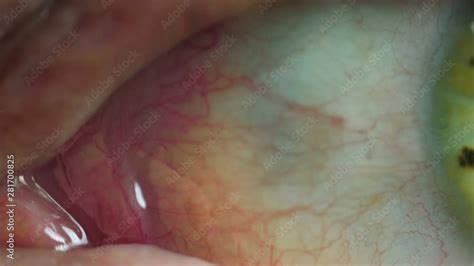 Lacrimal Caruncle And Tear Duct In Human Eye Macro Close Up Vídeo De