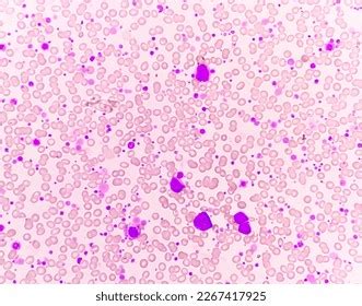 Chronic Myeloid Leukemia Cml Accelerated Phase Stock Photo Shutterstock