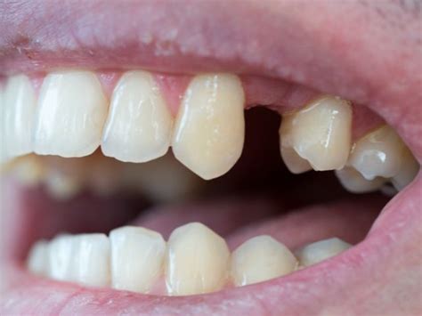 Can You Have Invisalign With Missing Teeth Smile Stories