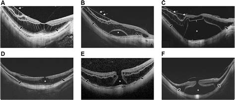 Myopic Traction Maculopathy Diagnostic And Management Strategies Opth