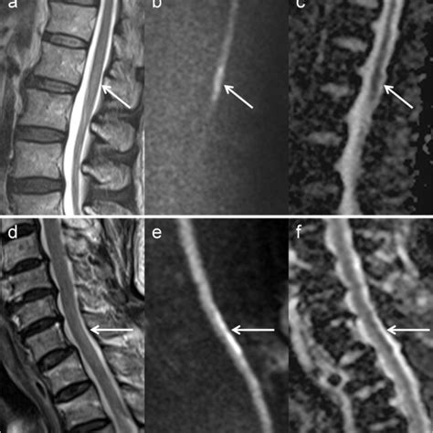 Early Ischemic Changes And Posterior Linear Hyperintensity Mri