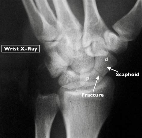 Scaphoid Fracture Complications Symptoms At Edwin Whitlow Blog