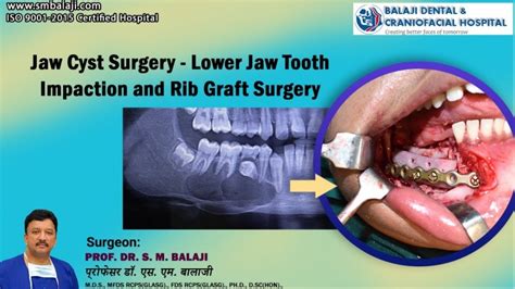 Balaji Sm On Linkedin Jaw Cyst Surgery Lower Jaw Tooth Impaction And Rib Graft Surgery
