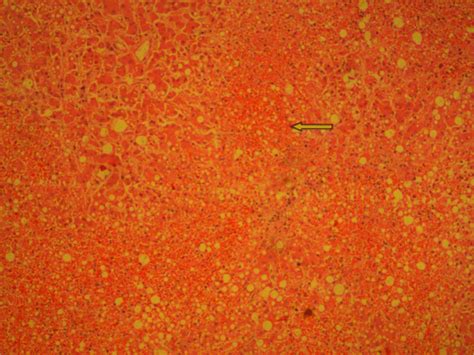 Liver × 100 Bringing Necrosis Shown In Arrow Download Scientific Diagram