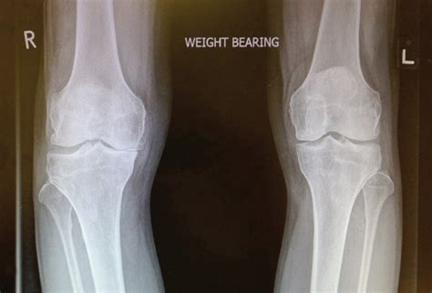 Knee Joint Preservation Cimed Healthcare