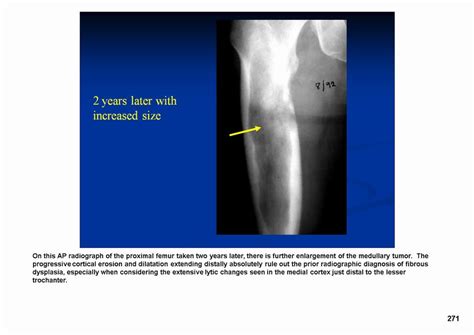 Dedifferentiated Chondrosarcoma An Atlas Of Musculoskeletal Oncology
