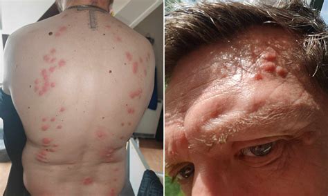 Man Left Covered In Bed Bug Bites After Hotel Stay