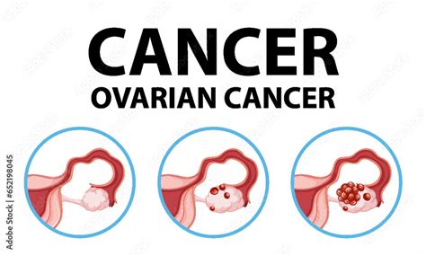 Medical Anatomy Infographic Woman S Ovarian Cancer Awareness Stock