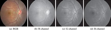 Figure 1 From Automatic Classification Of Cataract Based On Deep