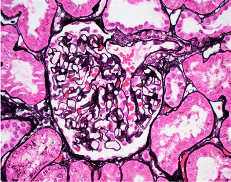 Pathology Outlines Obesity Related Glomerulopathy