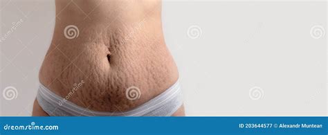 Skin Stretch Marks Stock Image Image Of Stomach Stretch 203644577