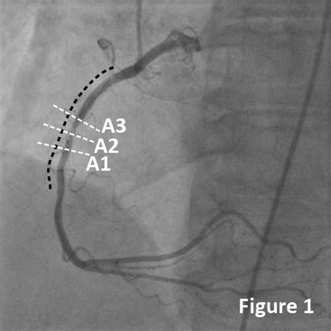 Orbital Atherectomy In Calcified Lesion Cardiology Apps