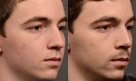 403b Male Rhinoplasty Dr Oakley Smith Toronto Nose Job Toronto