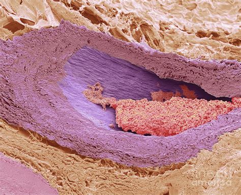 Tumour Blood Vessel Photograph By Steve Gschmeissnerscience Photo