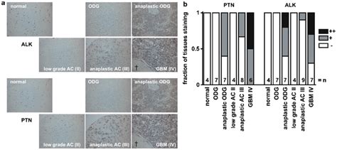 Anaplastic Lymphoma Kinase Alk And Pleiotrophin Ptn Expression In