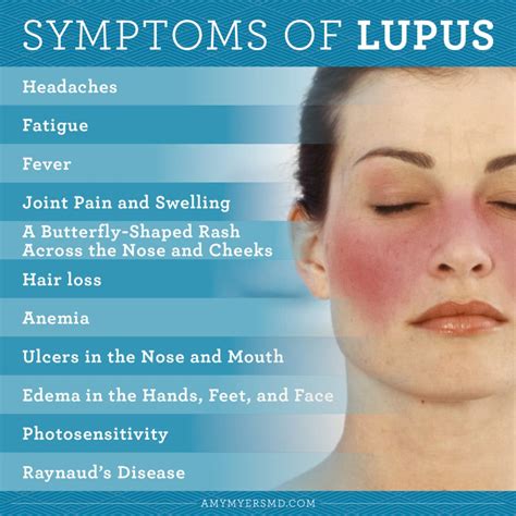 What Is Lupus The Early Signs Of Lupus