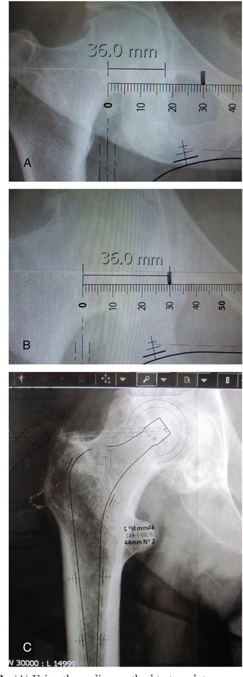 Figure 1 From Scaling Digital Radiographs For Templating In Total Hip Arthroplasty Using