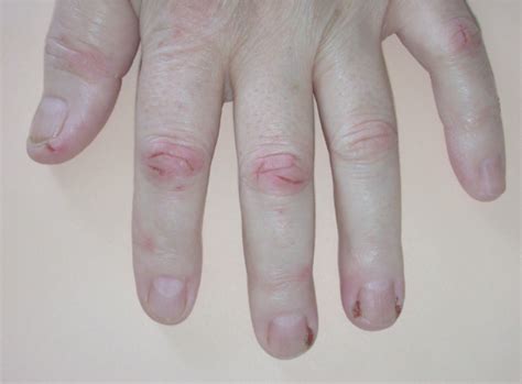 Efectos Cutáneos Adversos Causados Por Erlotinib Actas Dermo