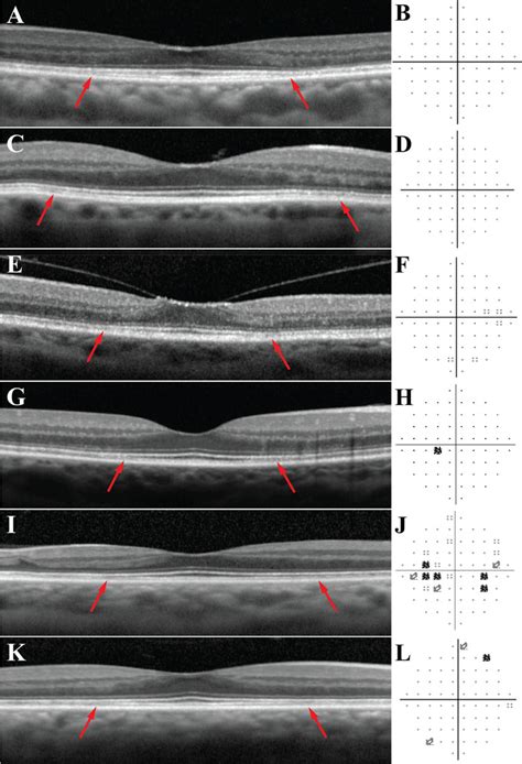 Patients With Abnormalities Noted In SD OCT Imaging Six Patients A