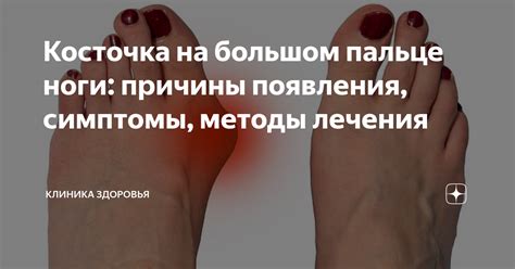 Косточка на большом пальце ноги причины появления симптомы методы