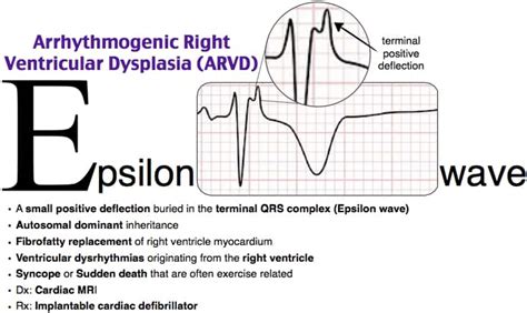 Arrhythmogenic Right Ventricular Dysplasia Arvd • Grepmed