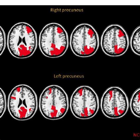 Significant Differences In Correlation In The Two Cognitive Performance Download Scientific