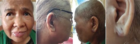 A D Clinical Improvements On Cutaneous Lesions After 6 Sessions Of