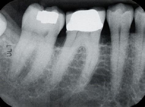 Periodontal Disease Causes And Side Effects Trusted Health Products
