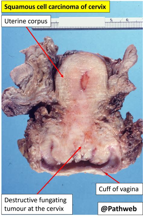 What Is Squamous Cell Carcinoma Of The Cervix