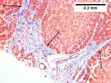 Primary Sclerosing Cholangitis Libre Pathology