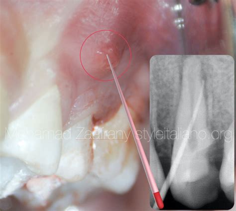 Gutta Percha In Tooth