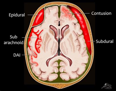 Subdural Hematoma Vs Subarachnoid Hemorrhage