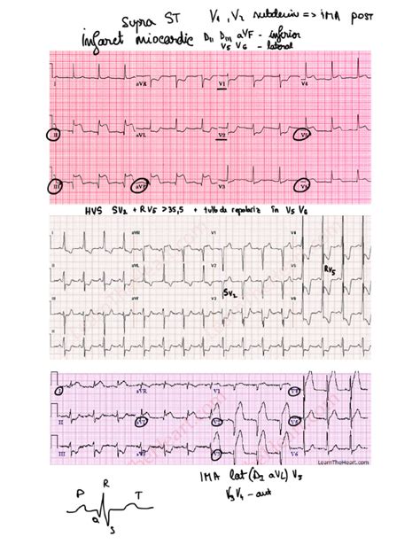 Ekg1 Pdf