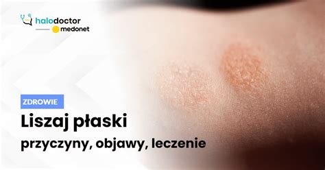 Liszaj P Aski Rodzaje Objawy Przyczyny I Leczenie Liszaj P Aski U Hot