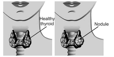 Thyroid Cancer Symptoms Treatment And Types Thyroid Nodules Pharmacy