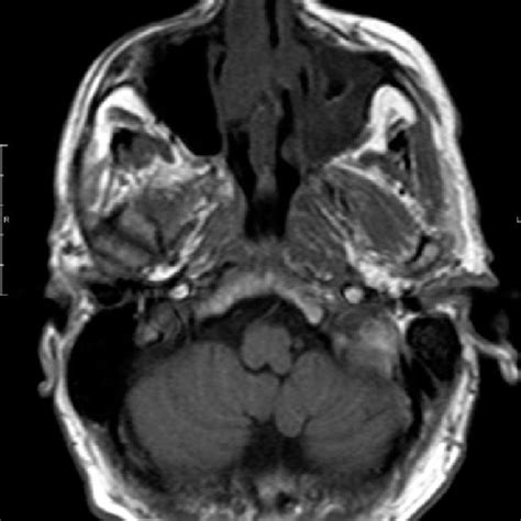 High Power View Of The Sinus Sphenoid Polyp Tissue Sections Shows