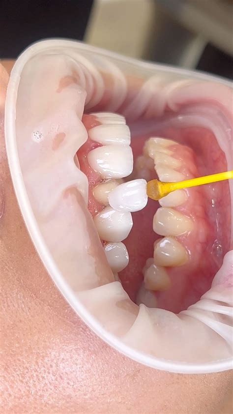 Minimal Prep Veneers [video] Healthy Teeth Teeth Whitening Implant Dentistry