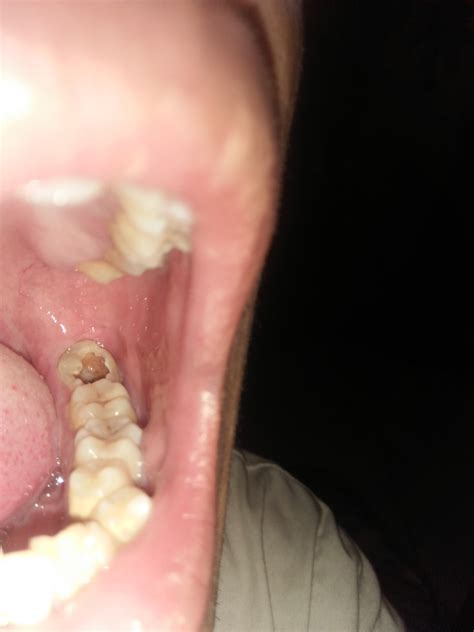 Jika Gigi Geraham Saya Sedang Dalam Keadaan Sakit Bolehkah Di Cabut Hellosehat